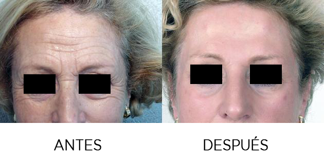 Peeling de fenol - AZERO LaClinic
